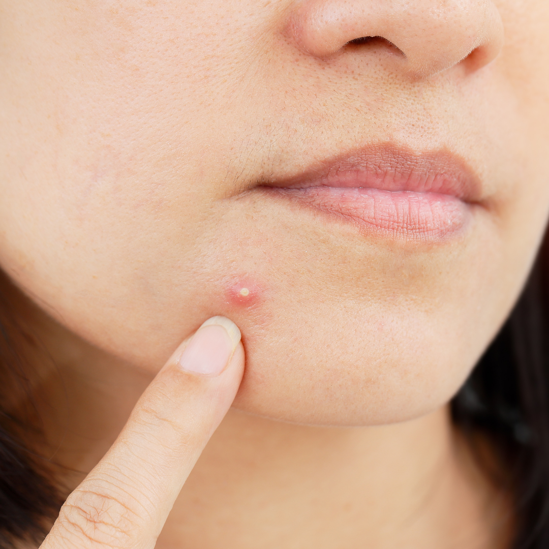 Banish Your Breakout: Our Top Tips for Healing Pimples The Gentle Way ...