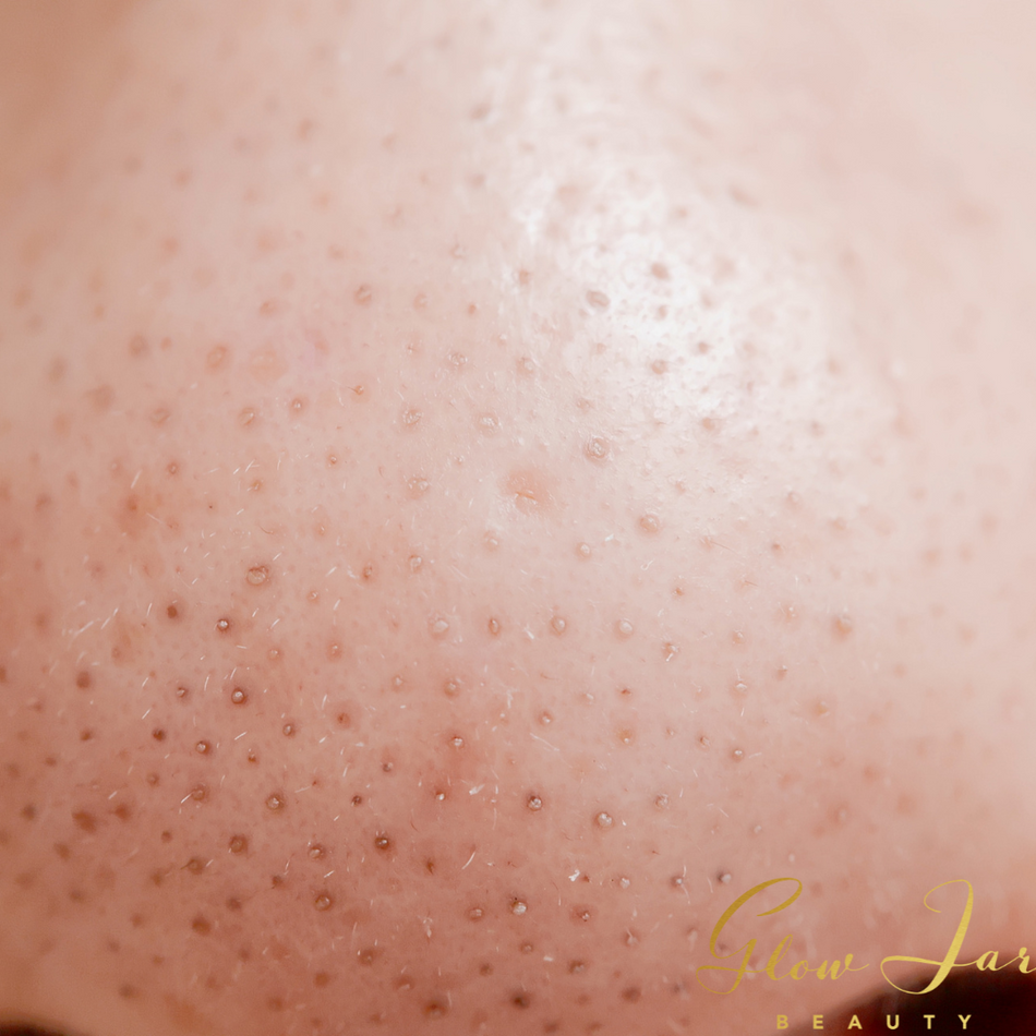 Blackheads Vs Sebaceous Filaments Key Differences And How To Deal Wi Glow Jar Beauty Inc