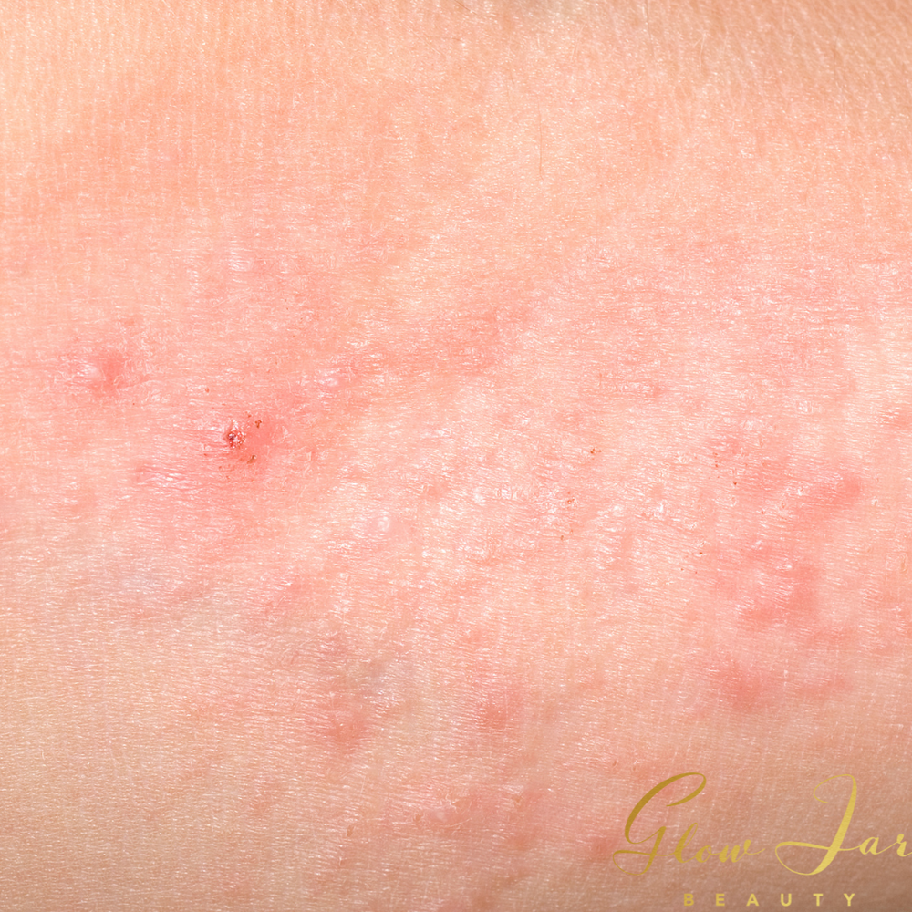 Troubleshooting Common Skin Conditions: How To Deal With Redness, Rash ...